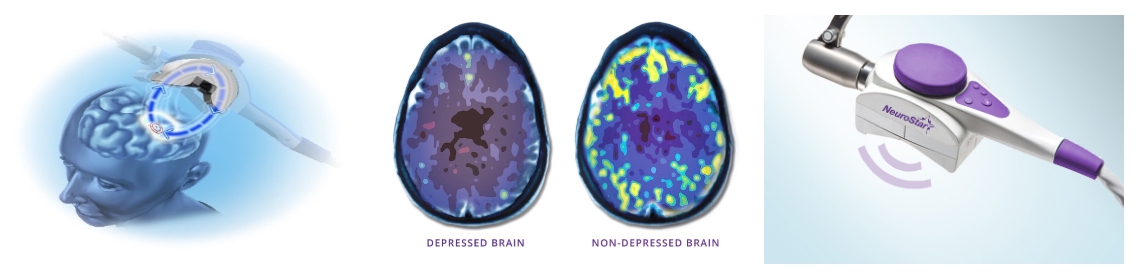 NeuroStar TMS Therapy in Spokane, WA | Revive Counseling